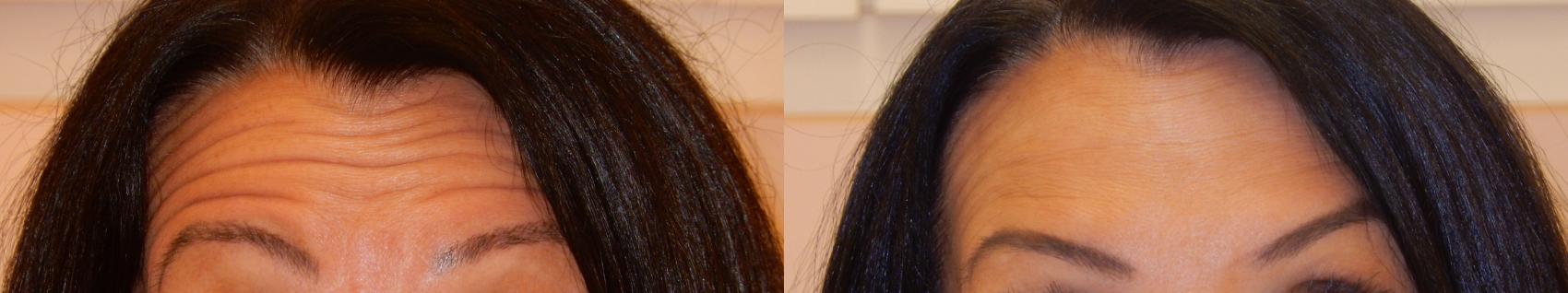 BOTOX® Cosmetic for Rochester, Victor & Syracuse, NY | Q the Medical Spa