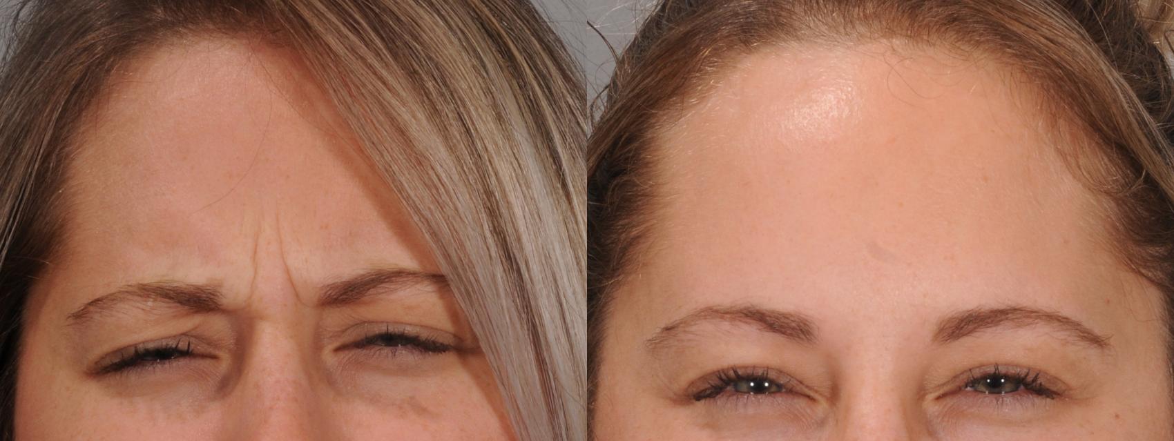 BOTOX® Cosmetic for Rochester, Victor & Syracuse, NY | Q the Medical Spa