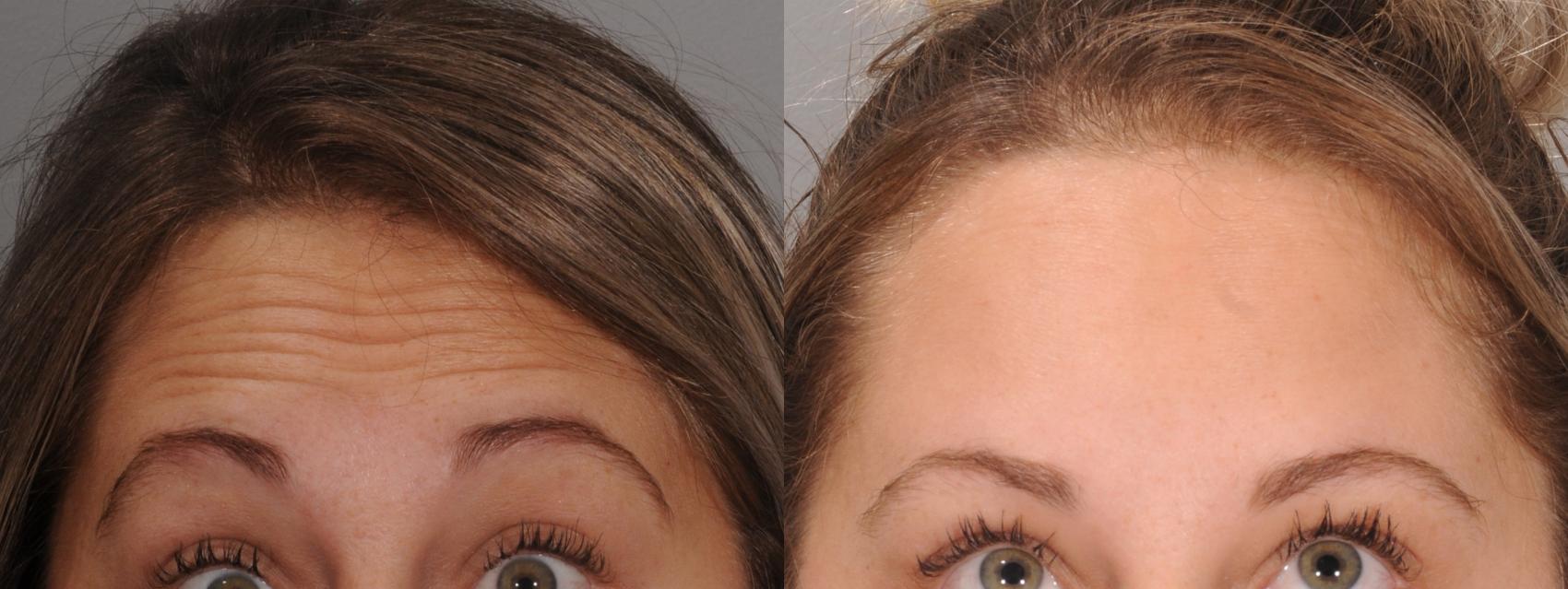 BOTOX® Cosmetic for Rochester, Victor & Syracuse, NY | Q the Medical Spa