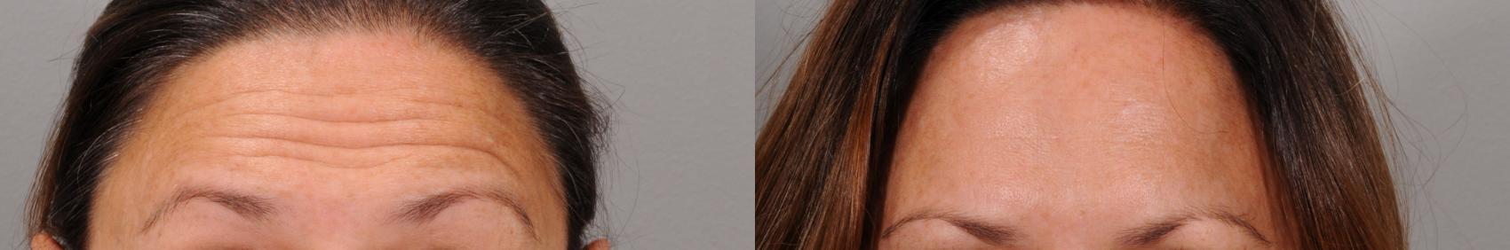 BOTOX® Cosmetic for Rochester, Victor & Syracuse, NY | Q the Medical Spa