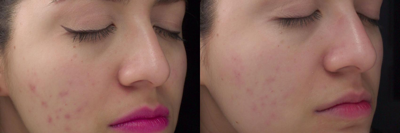 Chemical Peels & Microdermabrasion for Rochester, Victor & Syracuse, NY ...